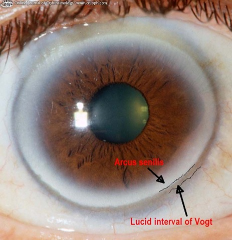 Medicine Decoded: Eponyms about Vogt - Ophthalmology